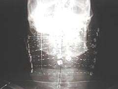 Head And Neck Cancer – Brachytherapy - Radiation Oncology | UCLA Health ...