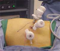Adrenal Surgery: What is Adrenalectomy? - Endocrine Surgery | UCLA Health