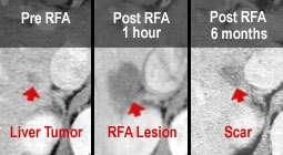 Radiofrequency and Microwave (Thermal) Ablation Procedures ...
