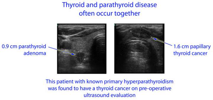Thyroid and Parathyroid Disease - Endocrine Surgery | UCLA Health
