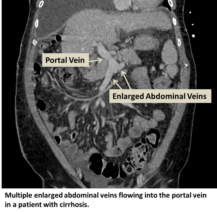 Portal Hypertension - Interventional Radiology | UCLA Health