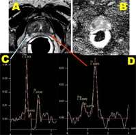 Prostate Cancer - Prostate Imaging | UCLA Health
