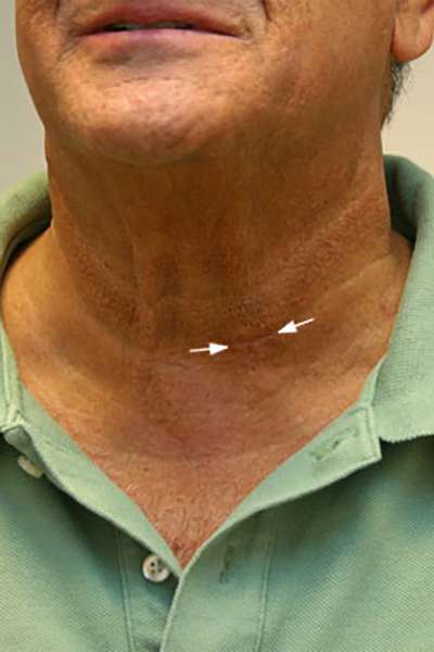 Scar Gallery - Endocrine Surgery | UCLA Health