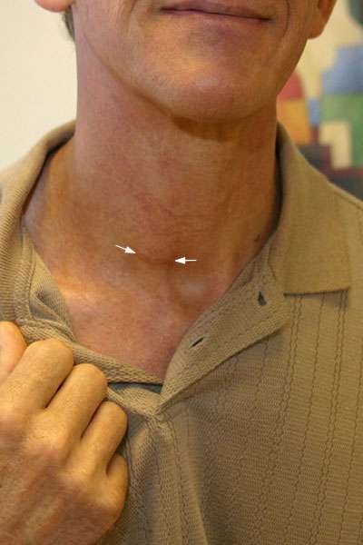Parathyroidectomy Scar Photos - Parathyroid Surgery Scar Photos ...