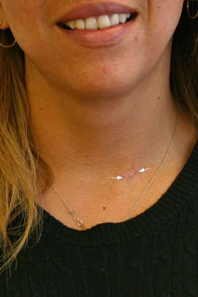 Parathyroidectomy Scar Photos - Parathyroid Surgery Scar Photos ...