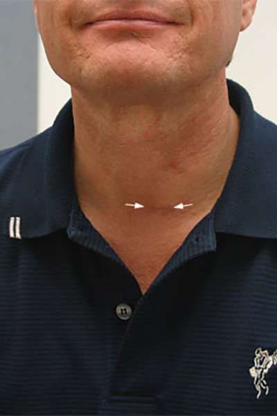 Parathyroidectomy Scar Photos - Parathyroid Surgery Scar Photos ...