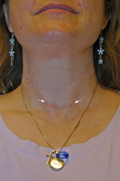 Thyroidectomy Scar Photos - Thyroid Cancer Surgery Scars - Endocrine ...