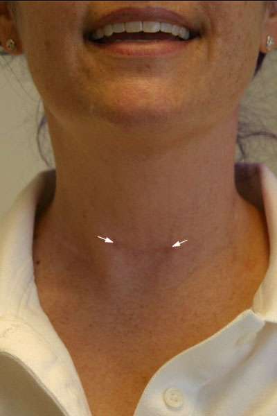 Thyroidectomy Scar Photos - Thyroid Cancer Surgery Scars - Endocrine ...