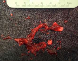 Cerebral Venous Sinus Thrombosis - Interventional Neuroradiology | UCLA ...