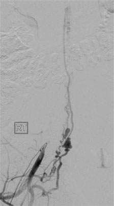Spinal Vascular Malformation - Interventional Neuroradiology | UCLA Health