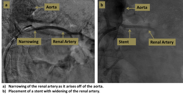 Stent Graft Placement - Interventional Radiology | UCLA Health