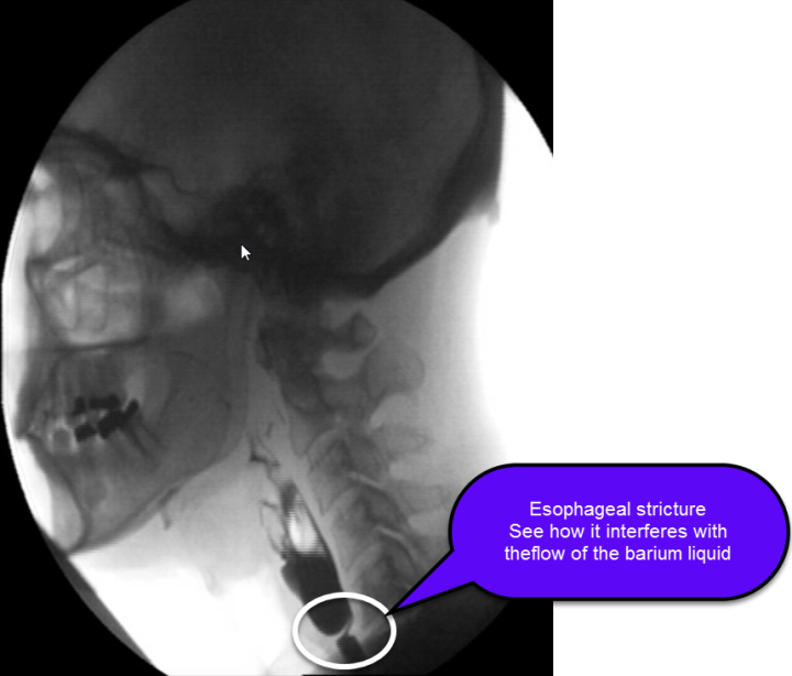Esophageal Stricture - Esophageal Health | UCLA Health