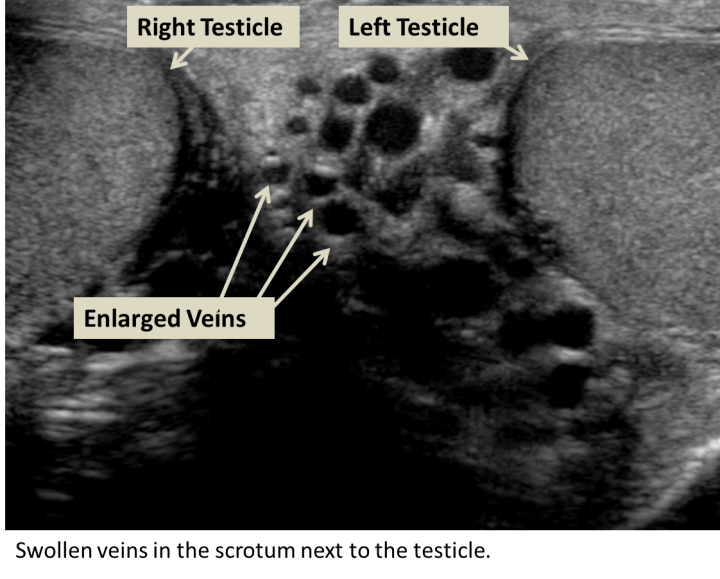 Varicocele - Interventional Radiology | UCLA Health