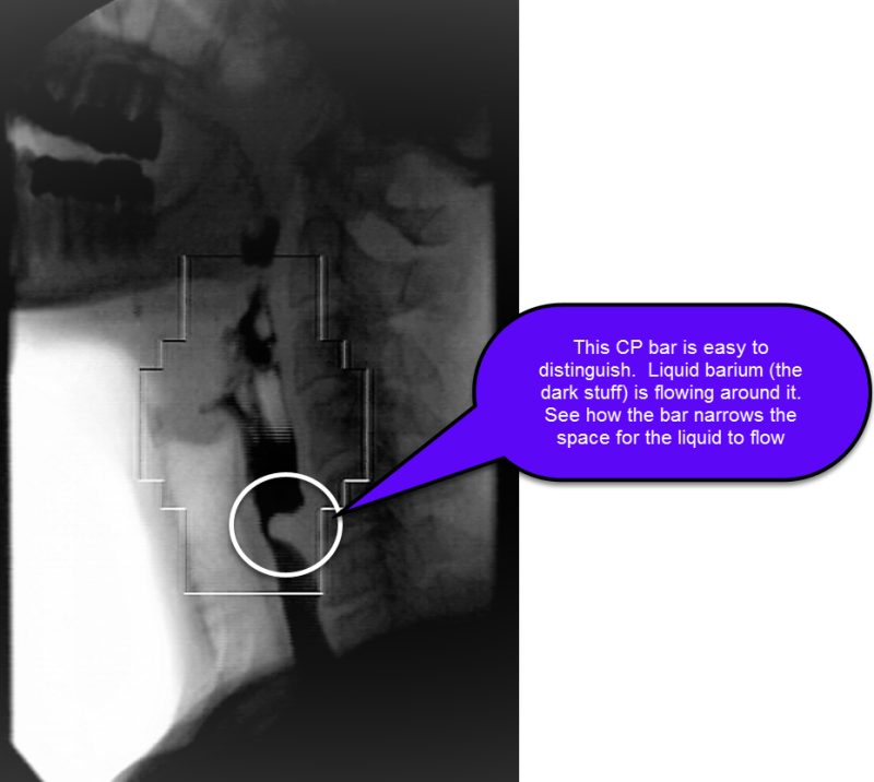 Cricopharyngeal Bar - Esophageal Health | UCLA Health