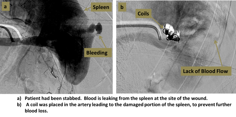 Embolization - Interventional Radiology | UCLA Health