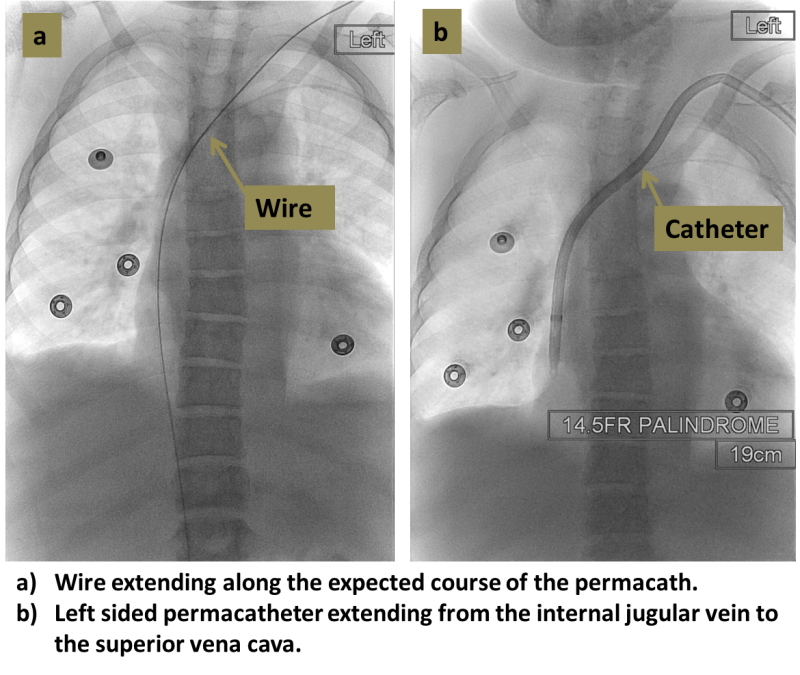 Vascular Access Procedures - Interventional Radiology | UCLA Health