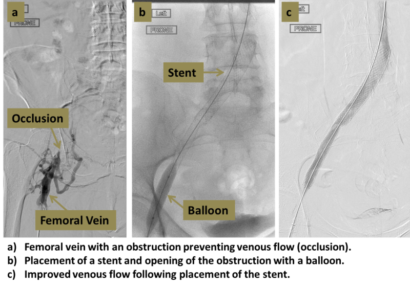 Venous thrombolysis and recanalization - Interventional Radiology ...