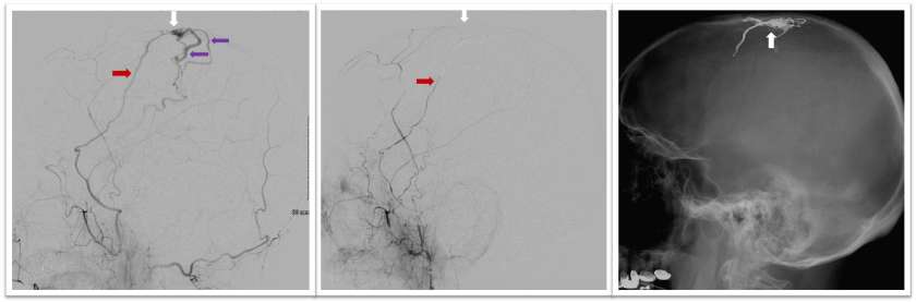 Dural Arteriovenous Fistula (DAVF) - Cerebrovascular Disease | UCLA Health