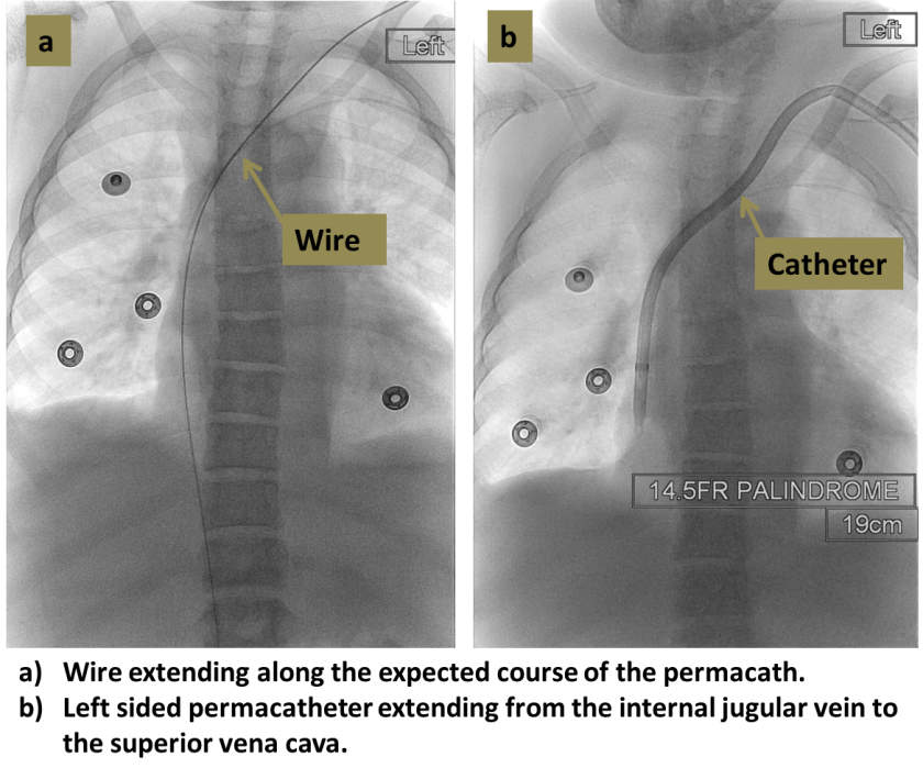 Vascular Access Procedures - Interventional Radiology | UCLA Health