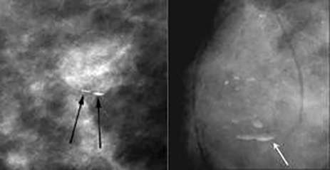 Mammography: Calcifications - Radiology | UCLA Health