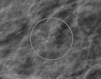 Case: Lobular Carcinoma in Situ (LCIS) - Radiology | UCLA Health