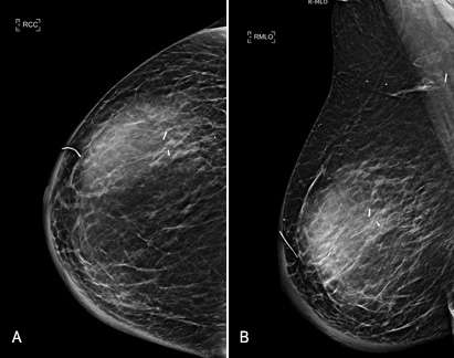 Seromas and Hematomas in the Breast - Radiology | UCLA Health
