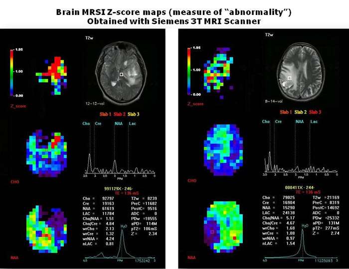 Functional Image-Guided Radiation Therapy - Radiation Oncology | UCLA ...