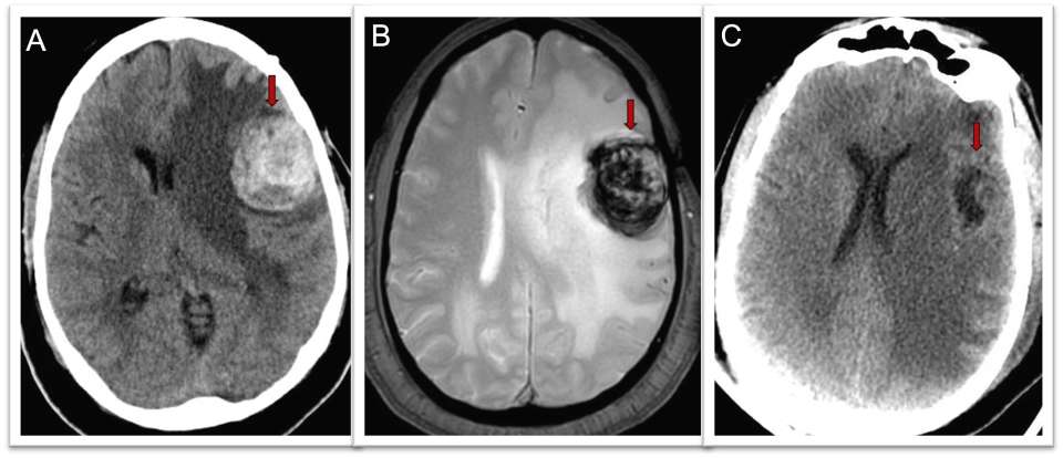 Cavernous Malformation - Cerebrovascular Disease | UCLA Health