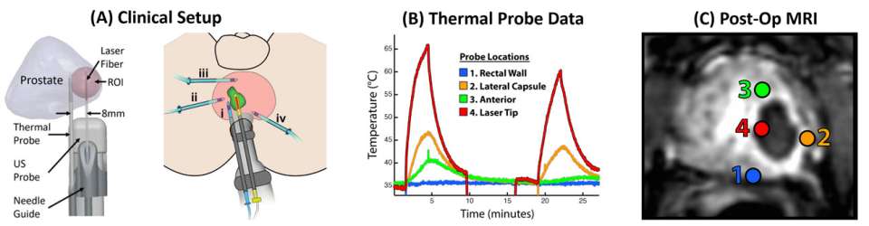 Focal Laser Ablation for Prostate Cancer Treatment - CASIT | UCLA Health