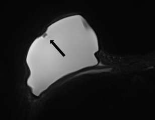 Breast MRI Findings: Breast Implant - Radiology | UCLA Health
