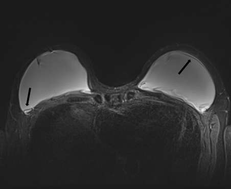Breast MRI Findings: Breast Implant - Radiology | UCLA Health