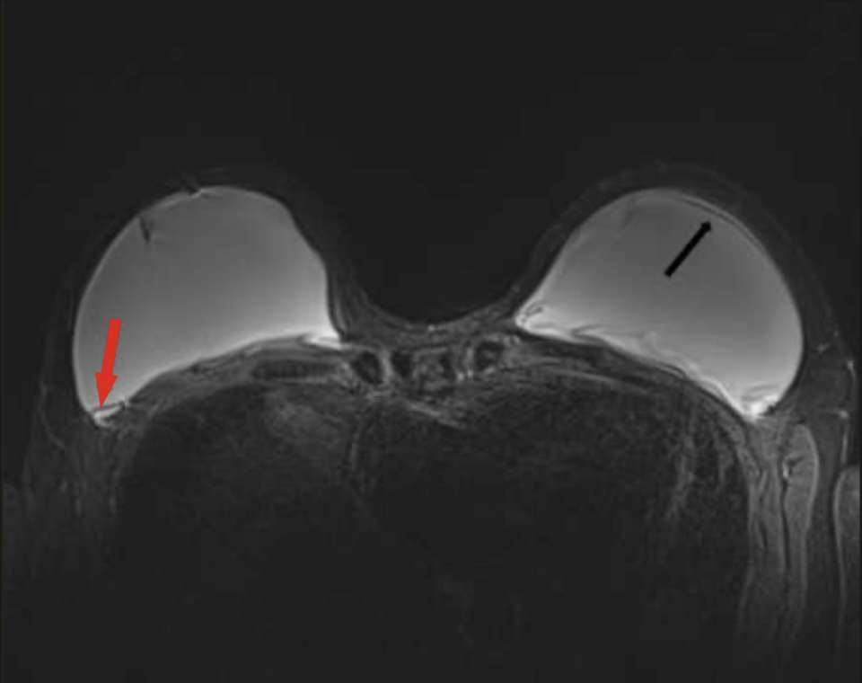 Breast MRI Findings: Breast Implant - Radiology | UCLA Health