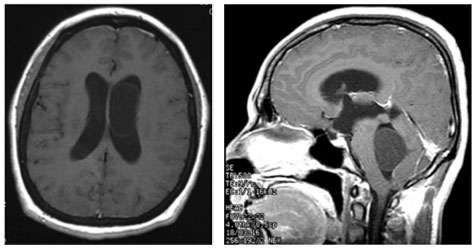 Neurocysticercosis - Neurosurgery | UCLA Health