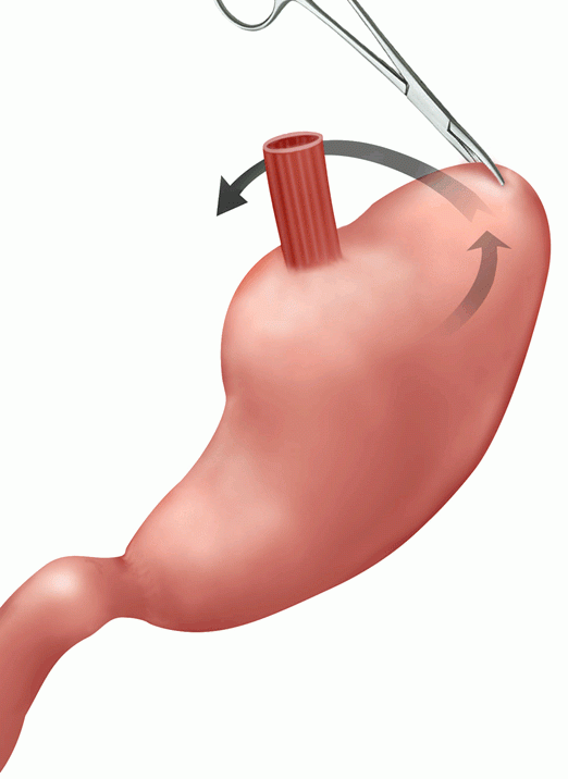 Nissen Fundoplication Illustrations - Bariatric Surgery | UCLA Health