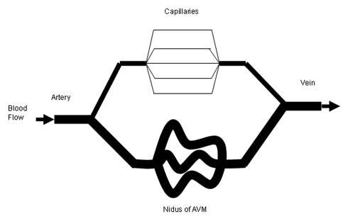 Arteriovenous Malformation - Interventional Neuroradiology | UCLA Health