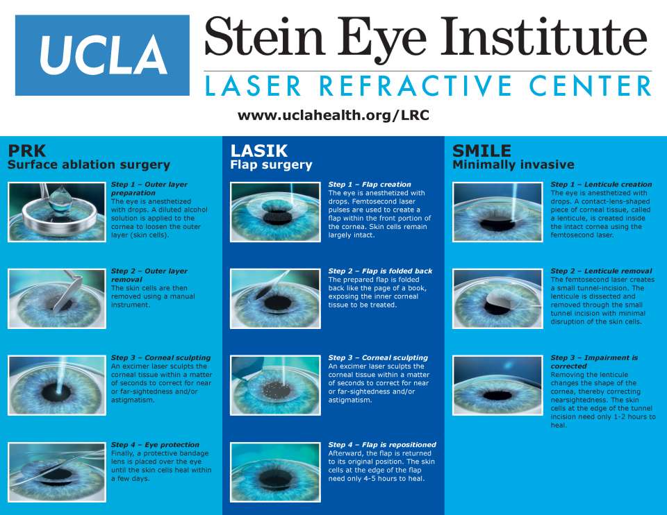 How Do I Decide? - Laser Refractive Surgery | UCLA Health
