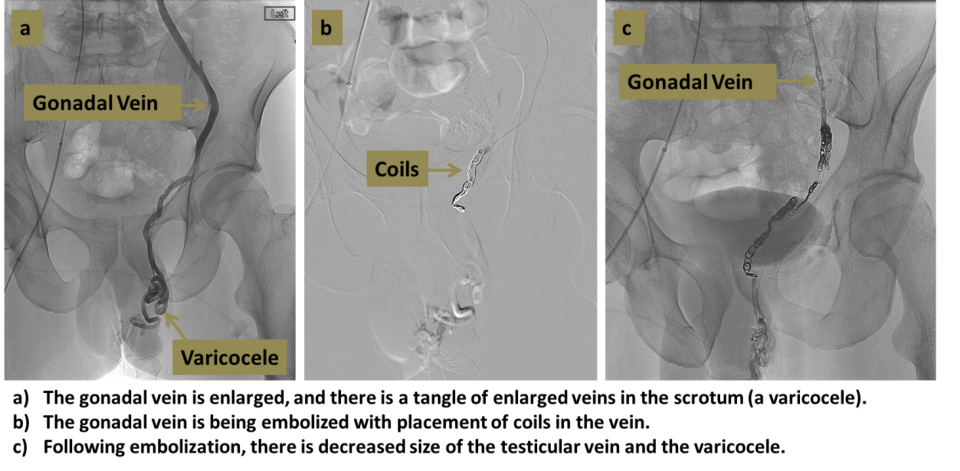 Varicocele Embolization - Interventional Radiology | UCLA Health