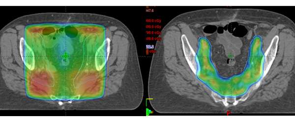 Intensity Modulated Radiotherapy (IMRT) - Radiation Oncology | UCLA Health