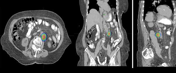 SBRT (Stereotactic Body Radiation Therapy) FAQs - Radiation Oncology ...