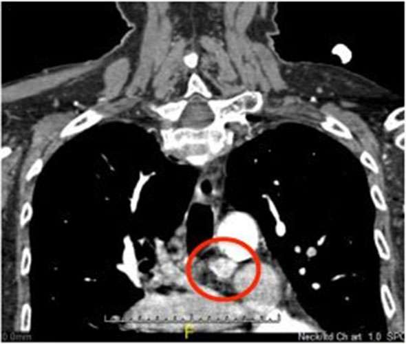 Parathyroid CT Scan Versus Nuclear Medicine Scan: Video - Endocrine ...