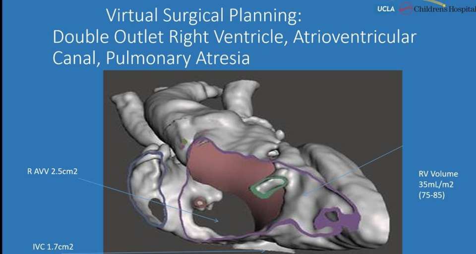 Congenital 3D Printing - Pediatric Cardiology | UCLA Health