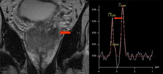 Extracapsular Extension and Seminal Vesicle Invasion - Prostate Imaging ...