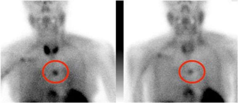 Parathyroid CT Scan Versus Nuclear Medicine Scan: Video - Endocrine ...