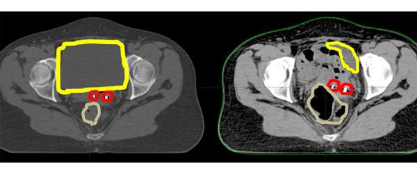 Gynecologic Cancers - Radiation Oncology | UCLA Health Jonsson ...