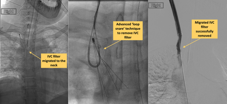IVC Filter Migration - IVC Filter | UCLA Health