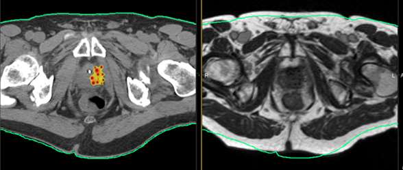 Prostate Cancer – Brachytherapy - Radiation Oncology | UCLA Health ...