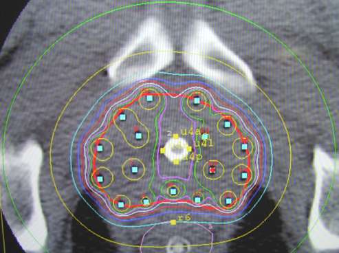 Prostate Cancer – Brachytherapy | UCLA Health Jonsson Comprehensive ...