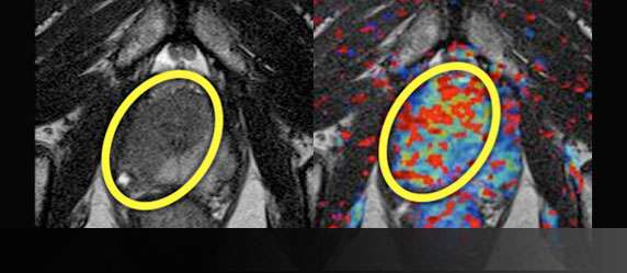 Radiation Therapy - Prostate Imaging | UCLA Health