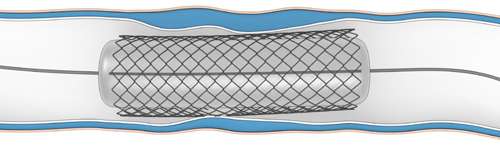 Stenting - Esophageal Health | UCLA Health