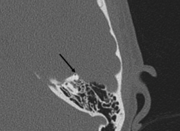 Semicircular Canal Dehiscence - Brain Tumor | UCLA Health Jonsson ...